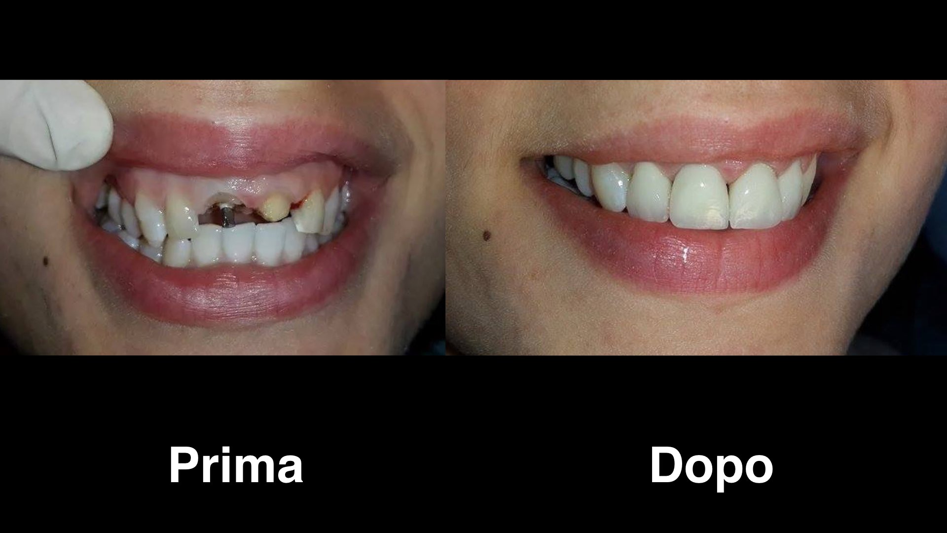 Salvataggio incisivi centrali con capsule bianche - Sos Turismo Dentale