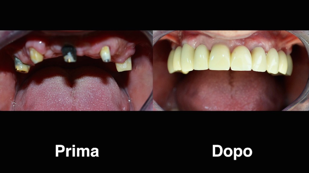 Protesi ponte circolare su denti naturali in Zirconio e Ceramica - Sos ...